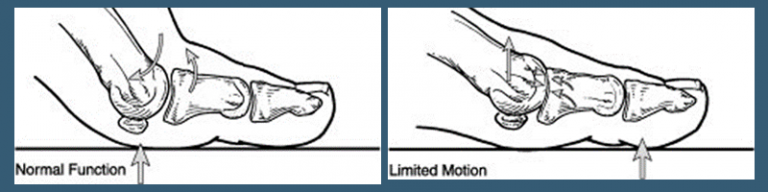 Hallux Limitus Rigidus | Sole Remedy Foot Care