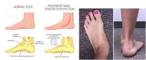 Posterior Tibial Tendinitis | Sole Remedy Foot Care