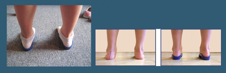 Corrective Prefabricated Orthotics | Sole Remedy Foot Care