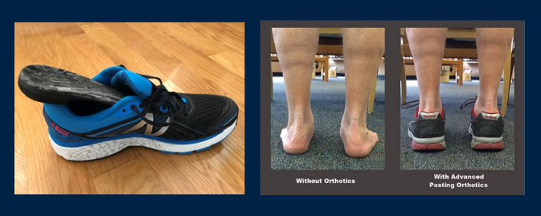 Tibial Shin Splints | Sole Remedy Foot Care